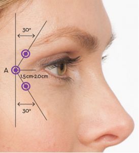 Como funciona o Botox - Injectors Club