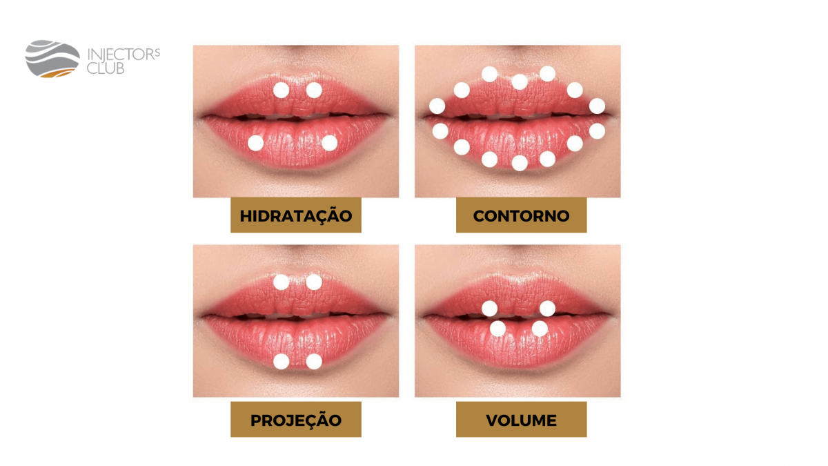 Preenchimento Labial - Injectors Club