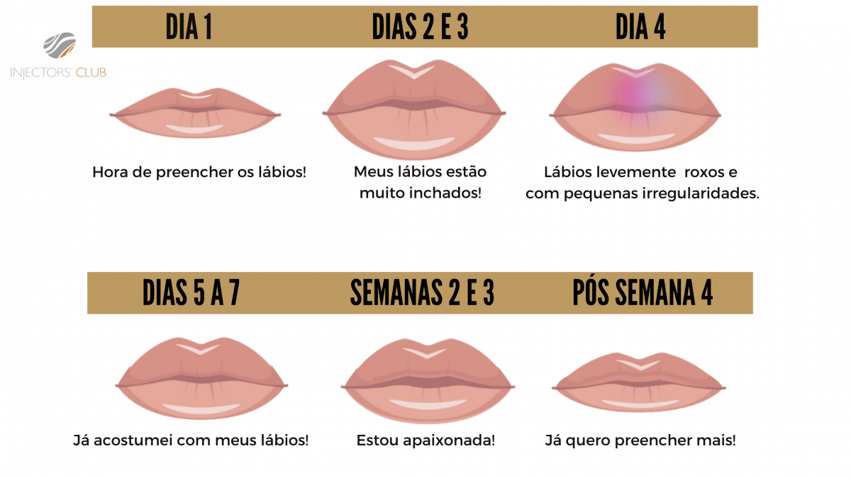 Preenchimento Labial - Injectors Club