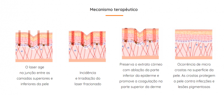 Aplicação do Lavieen em São Paulo - Injectors Club
